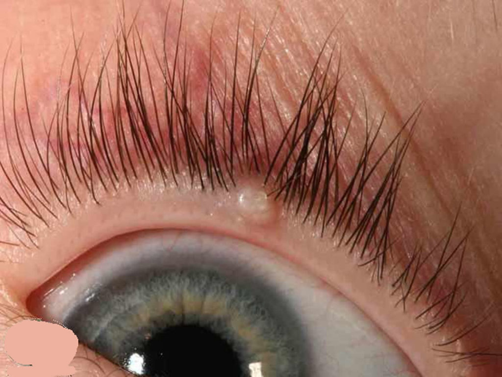 Pimple On Eyelid Types Causes How To Treat Them pimple-on-eyelid-types-causes-how-to-treat-them