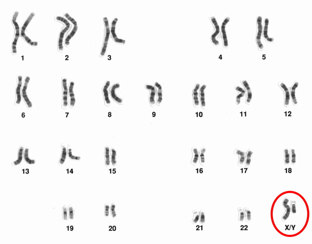 Klinefelter Syndrome Causes Karyotype Diagnosis Treatment