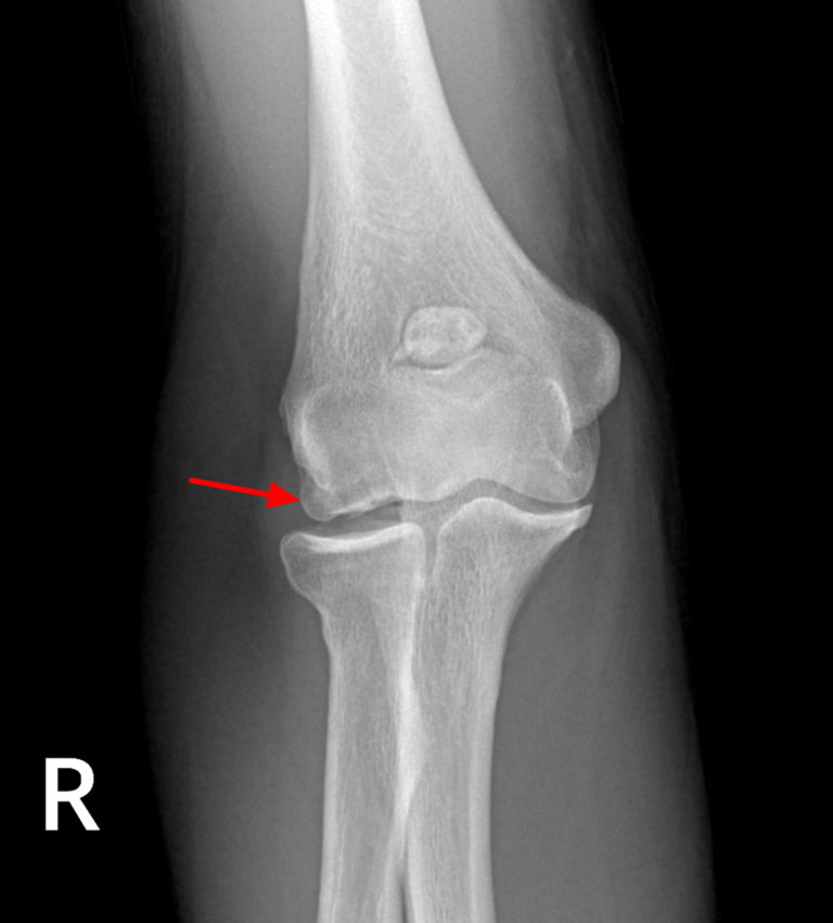 Osteochondritis Dissecans Causes Symptoms Diagnosis And Treatment