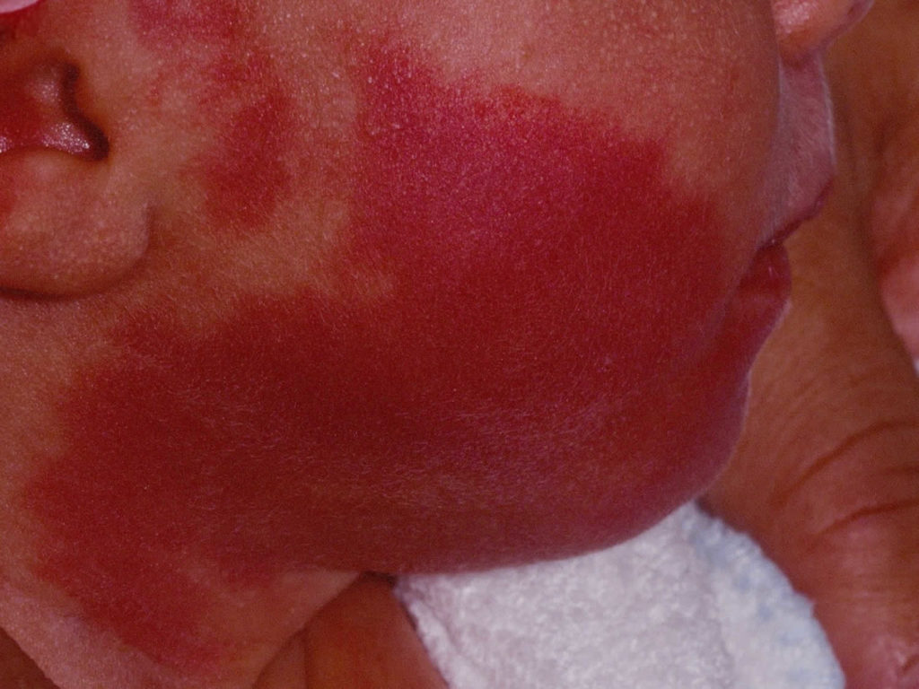 Birthmark Causes Types Of Birthmarks And How To Get Rid Of Birthmarks