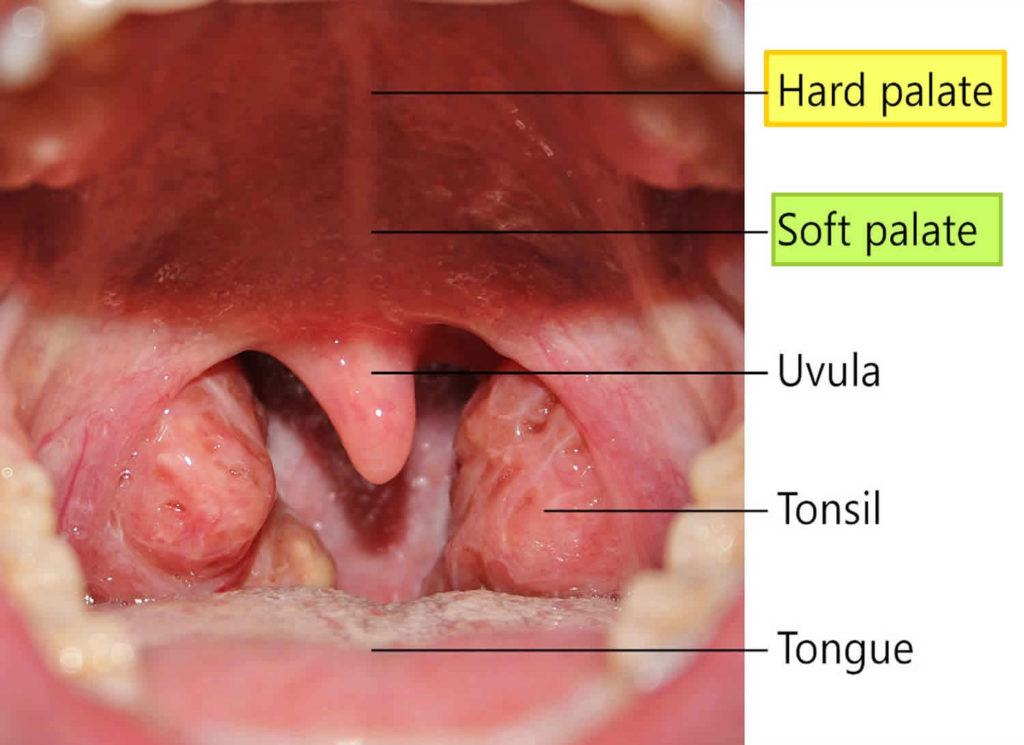 Soft palate anatomy, soft palate function and soft palate cancer Soft palate anatomy, soft palate function and soft palate cancer