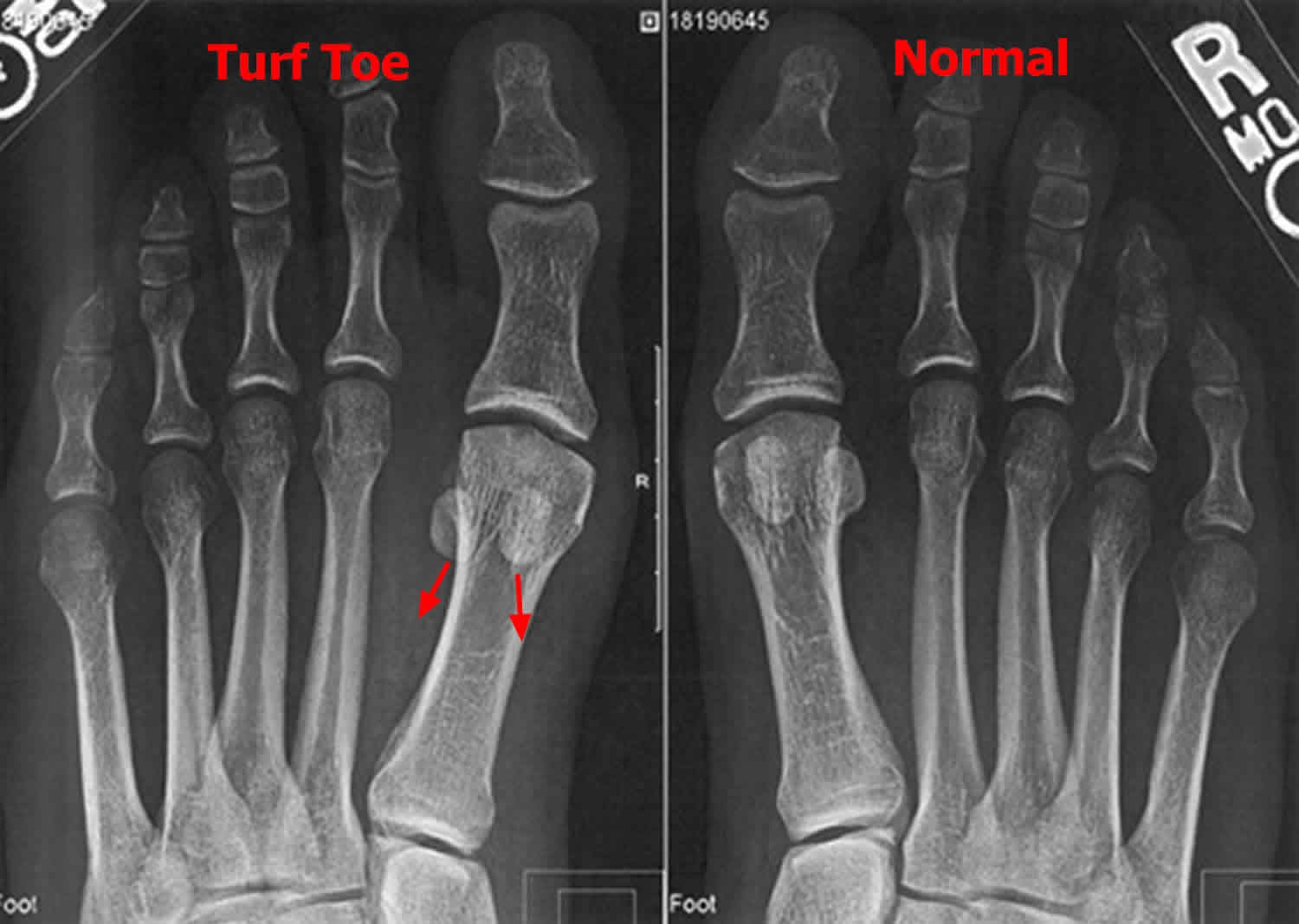 Turf toe causes, signs, symptoms, recovery, diagnosis & turf toe treatment Turf toe causes, signs, symptoms, recovery, diagnosis & turf toe treatment