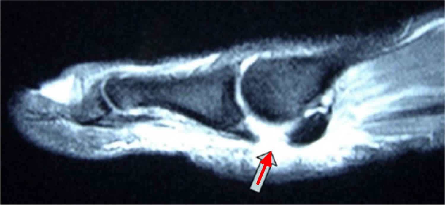 Turf toe causes, signs, symptoms, recovery, diagnosis & turf toe treatment Turf toe causes, signs, symptoms, recovery, diagnosis & turf toe treatment