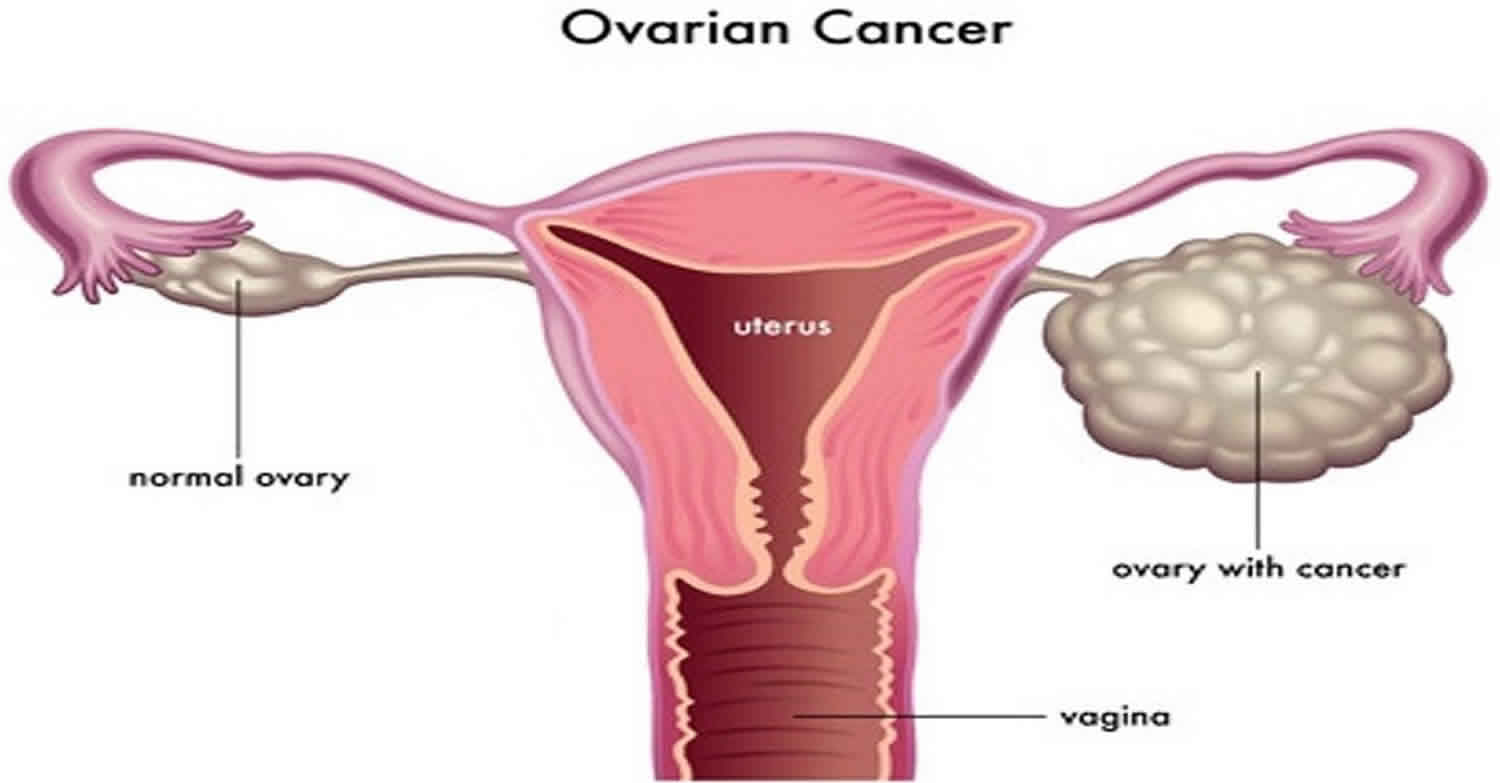 Ovarian Cancer Causes Symptoms Diagnosis Survival Rate And Treatment