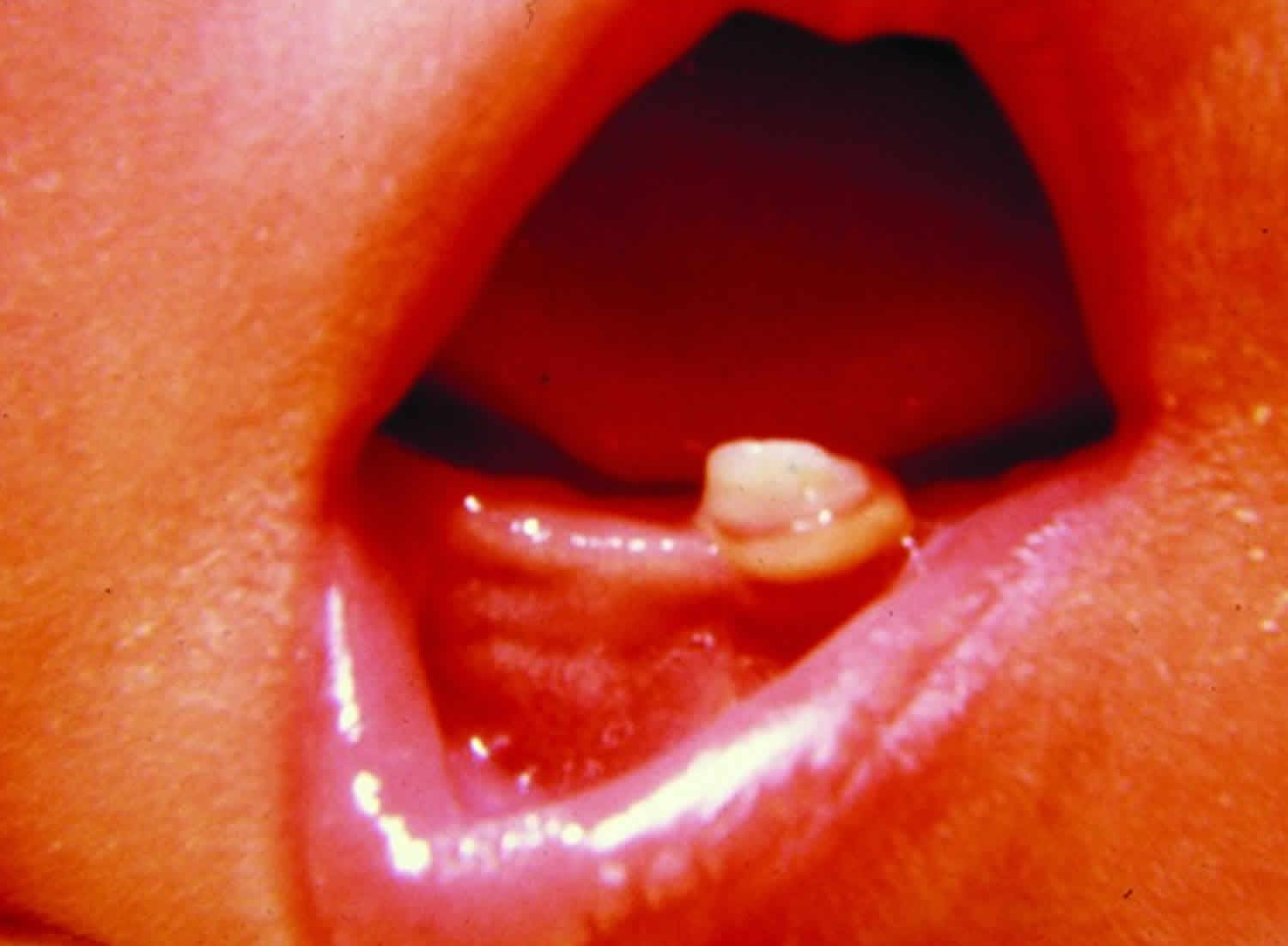 Epstein Pearls Causes Signs Symptoms Diagnosis And Treatment