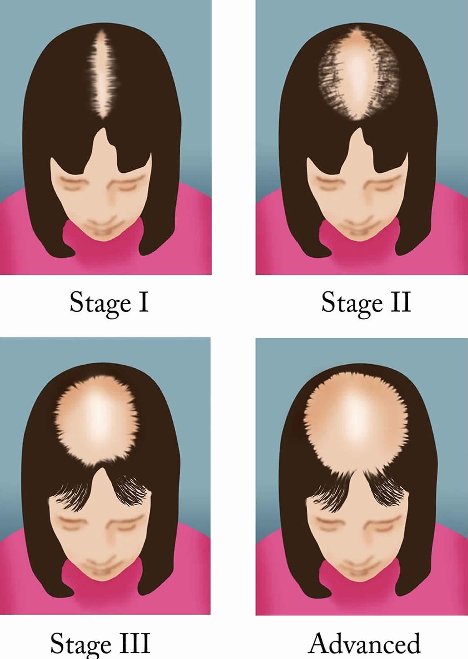 Male Or Female Pattern Baldness Causes And Baldness Treament