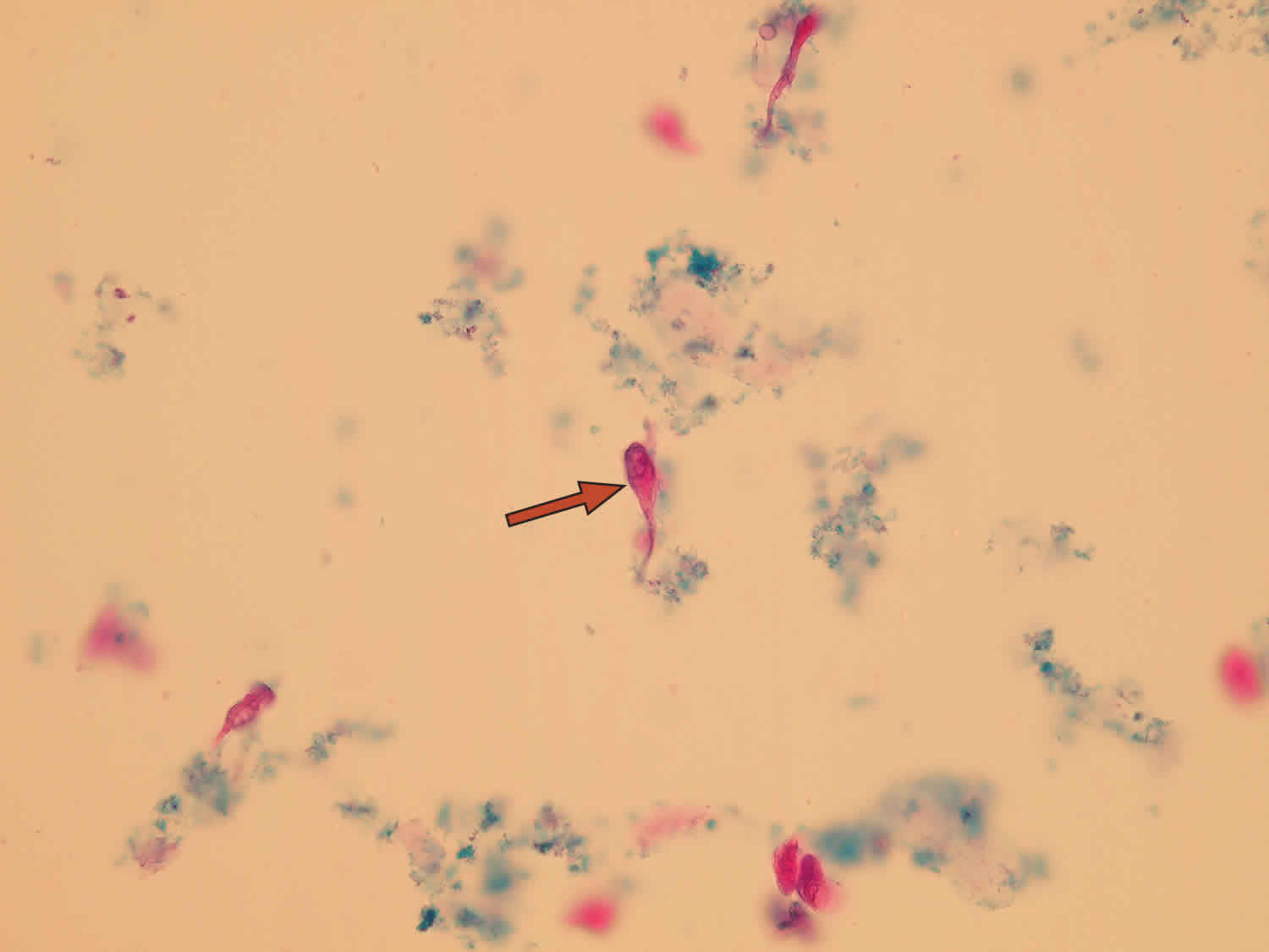 Epithelial Cells In Urine What Does It Mean If You Have Epithelial Cells In Urine