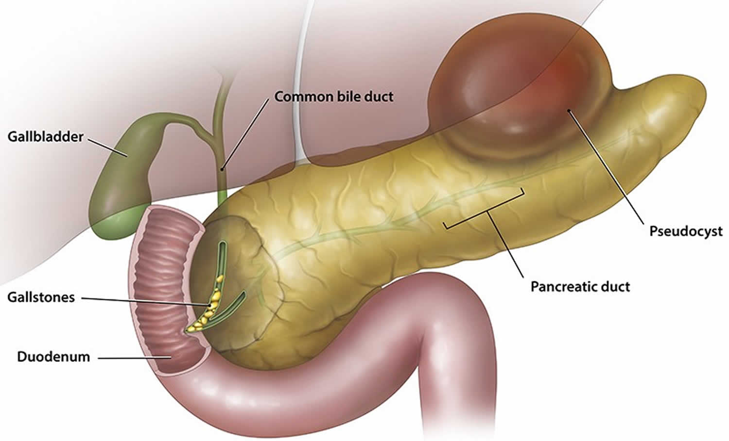 Pancreatic Pseudocyst Causes Symptoms Diagnosis Treatment Prognosis