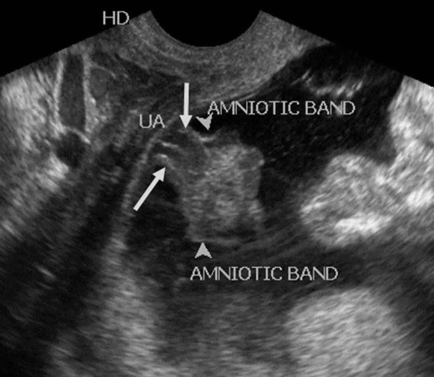 Amniotic Band Syndrome Causes Symptoms Diagnosis Treatment