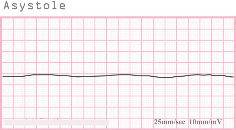 Asystole Definition ECG EKG Asystole Treatment asystole-definition-ecg-ekg-asystole-treatment