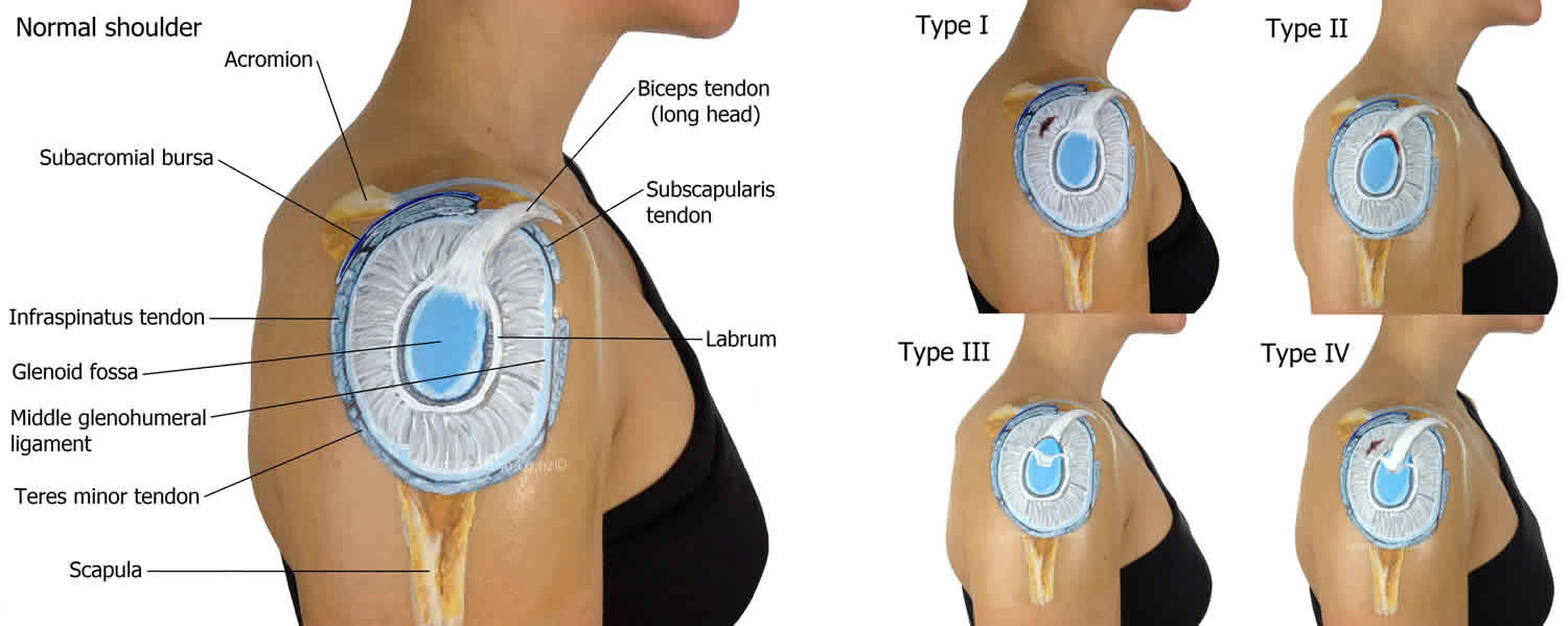 Labrum Cartilage Tear Shoulder Causes Symptoms Diagnosis Treatment