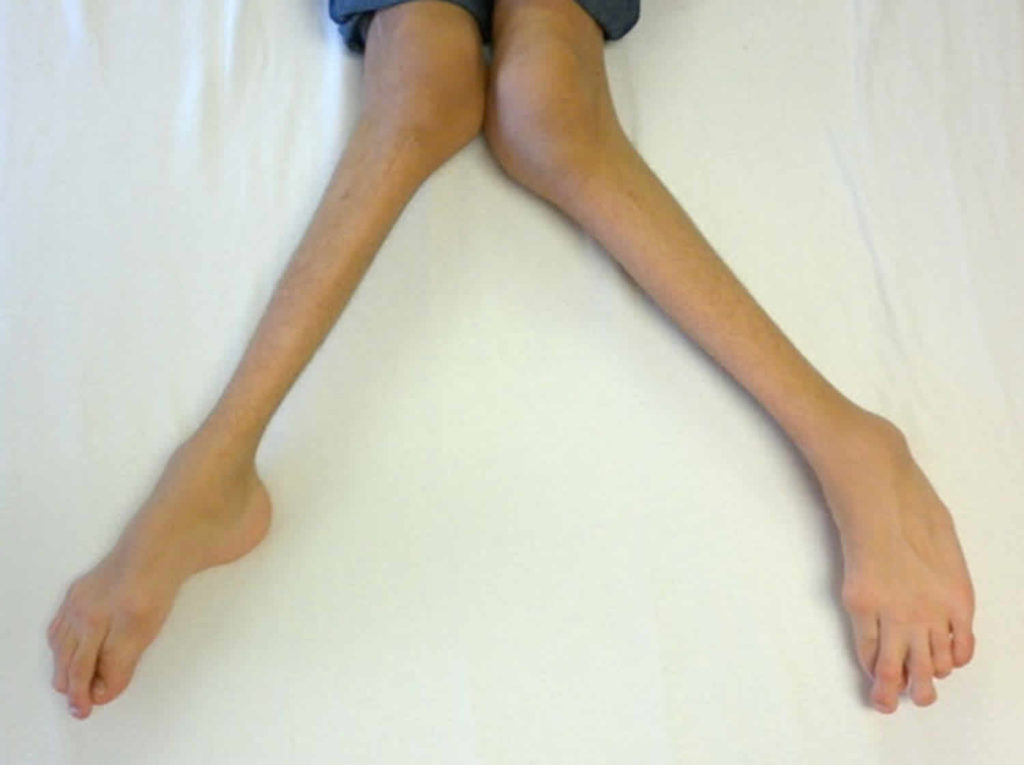 Morquio Syndrome Causes Symptoms Diagnosis Life Expectancy And Treatment