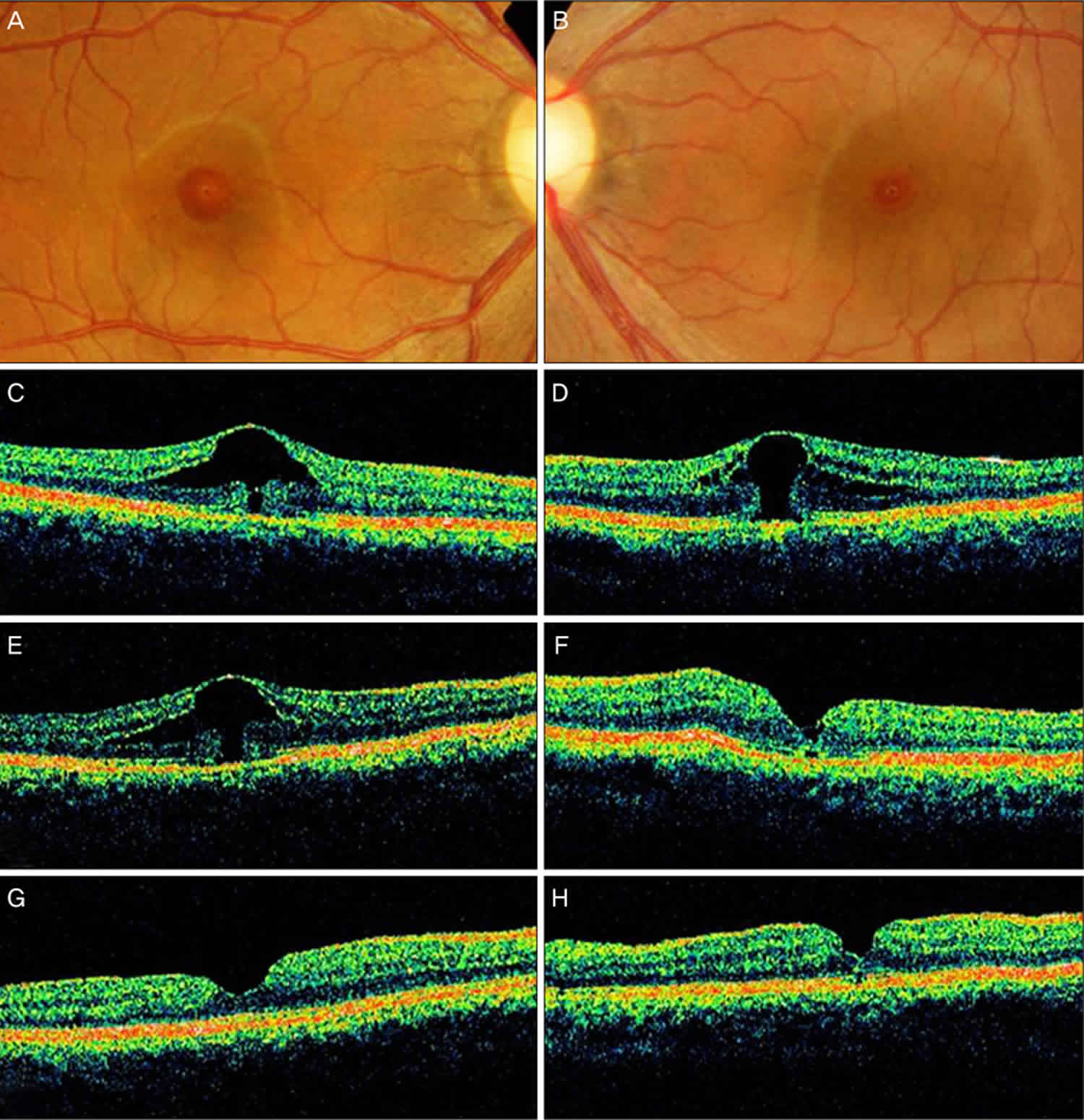 Macular Hole Causes Symptoms Diagnosis Treatment Prognosis
