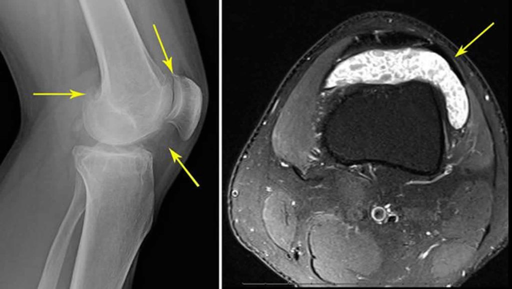 Synovial Chondromatosis Causes Symptoms Diagnosis Treatment And Prognosis