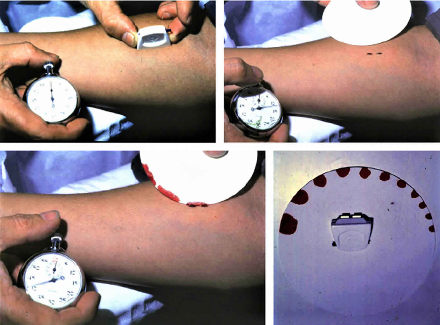 Bleeding Time Bleeding Time Lab Test Bleeding Time Normal Range