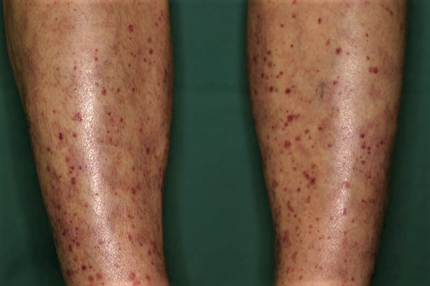 Microscopic Polyangiitis Causes Symptoms Diagnosis Treatment Prognosis