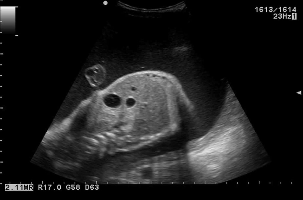 Duodenal Atresia Causes Symptoms Diagnosis Treatment And Prognosis