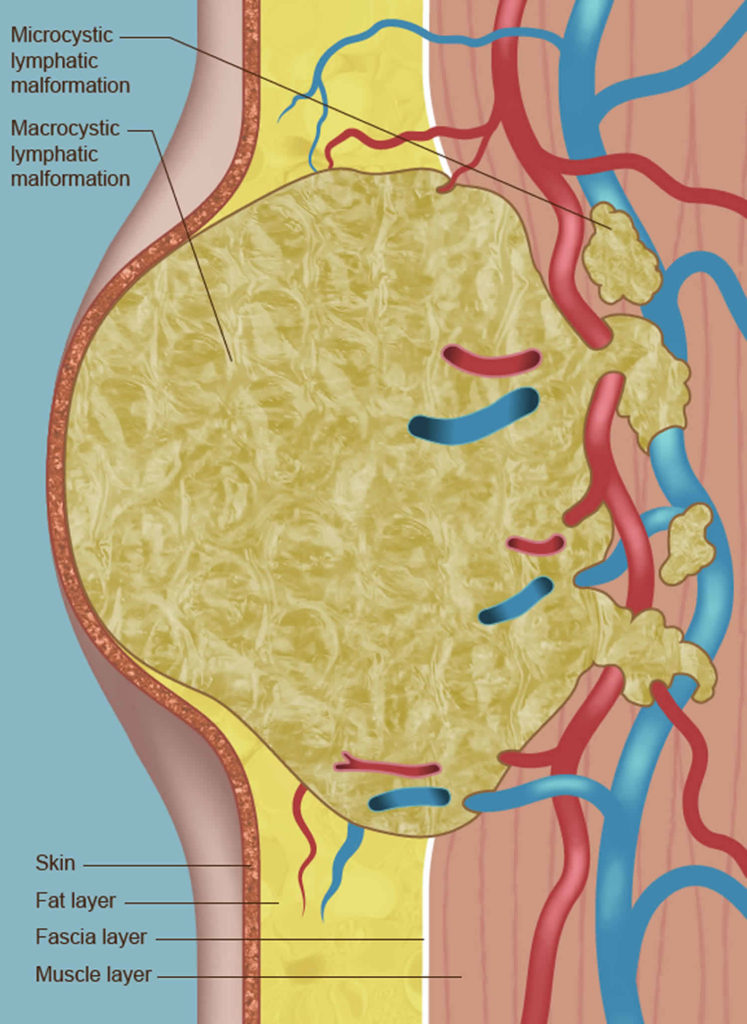 Lymphatic malformation causes, symptoms, diagnosis, treatment & prognosis Lymphatic malformation causes, symptoms, diagnosis, treatment & prognosis