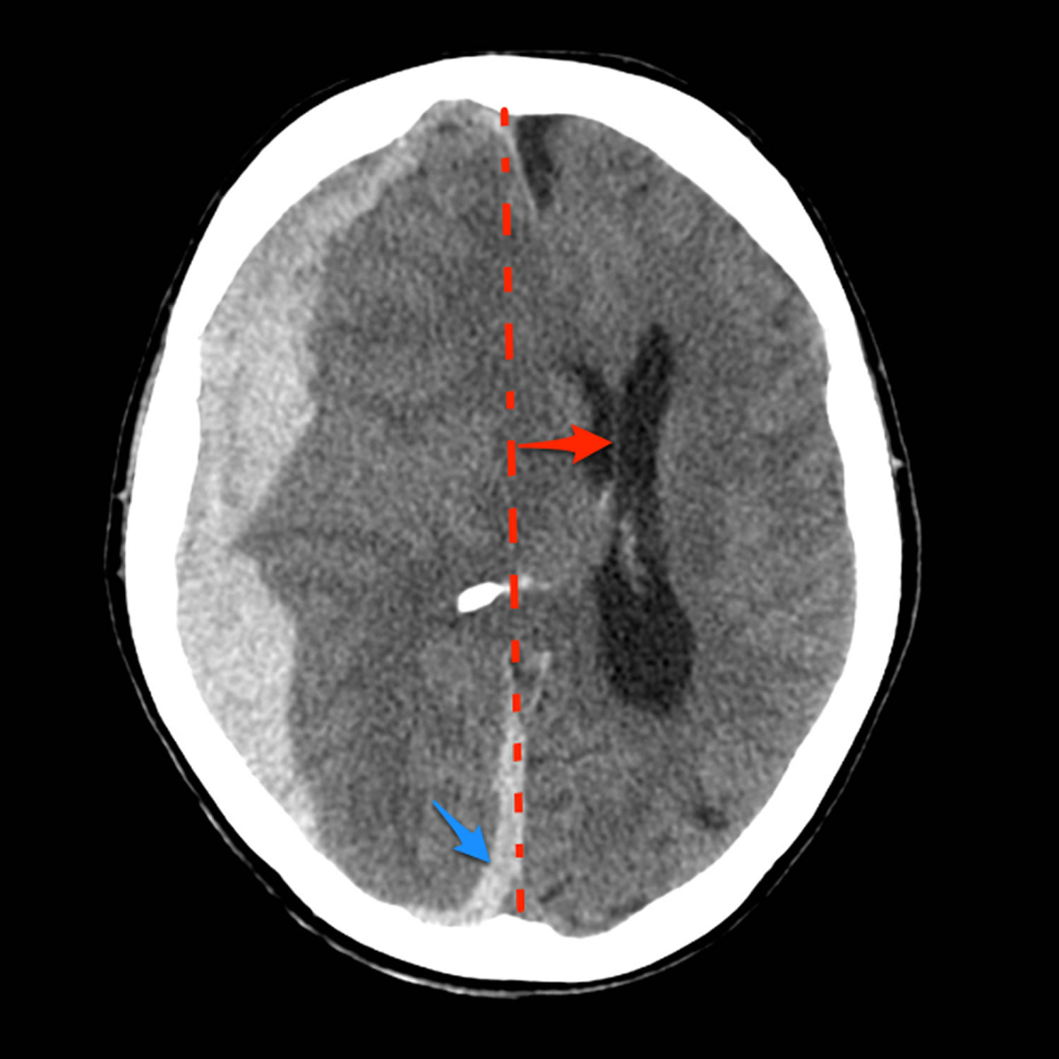 Midline Shift Brain Causes Symptoms Diagnosis Treatment