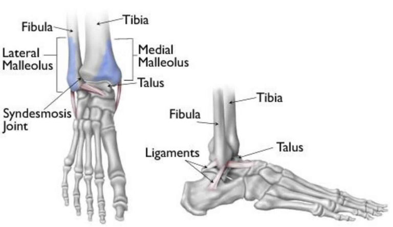 Bimalleolar Fracture Causes Symptoms Diagnosis Treatment And Recovery