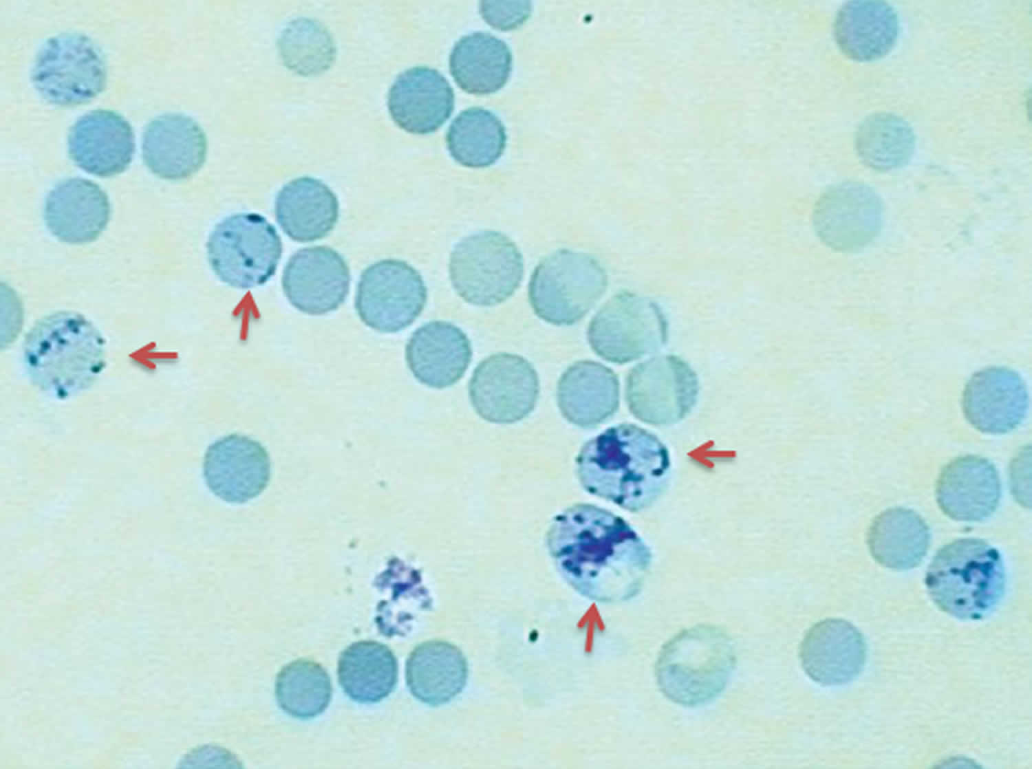 Anemia Reticulocyte