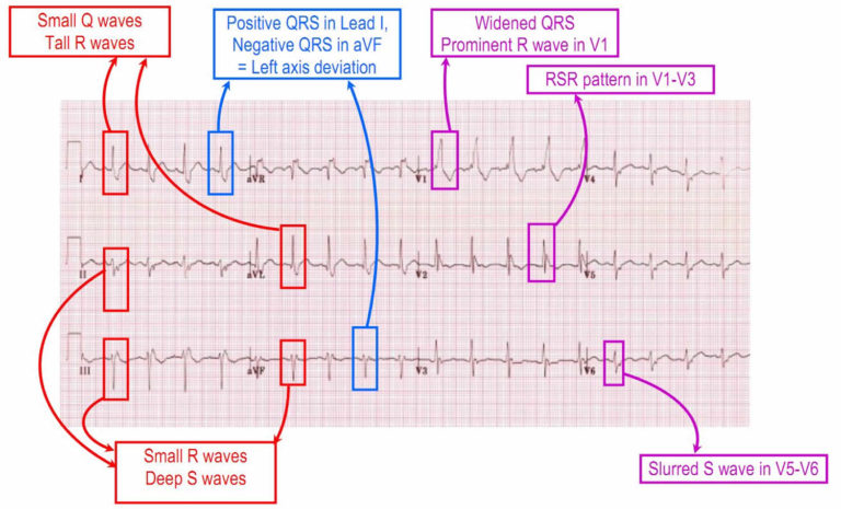 Bifascicular Block Causes Symptoms Diagnosis And Treatment