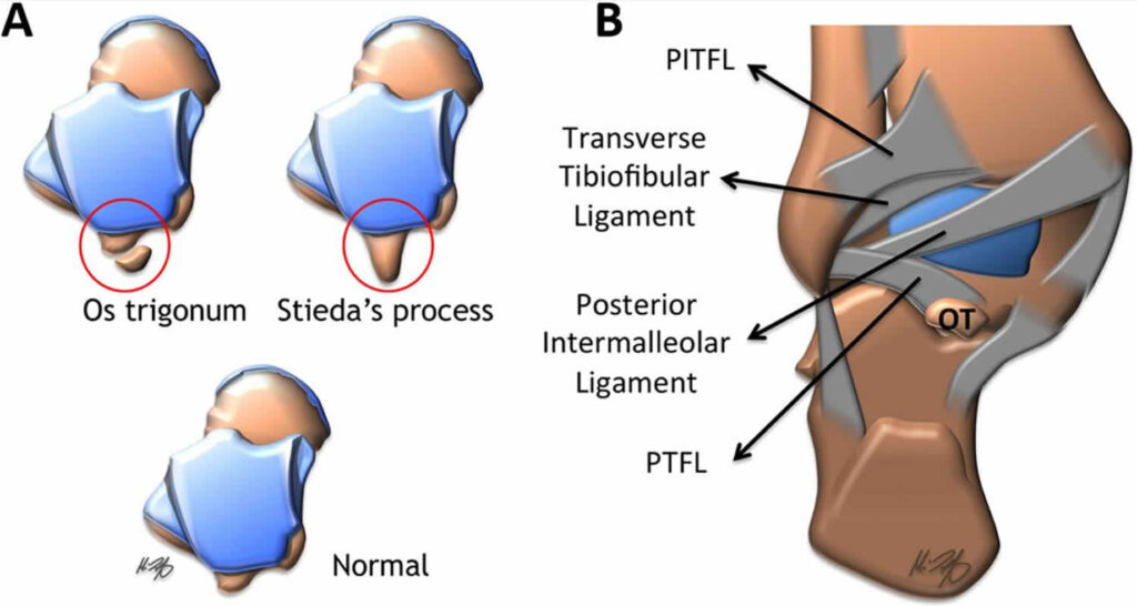 Ankle Impingement Syndrome Causes Symptoms Diagnosis And Treatment