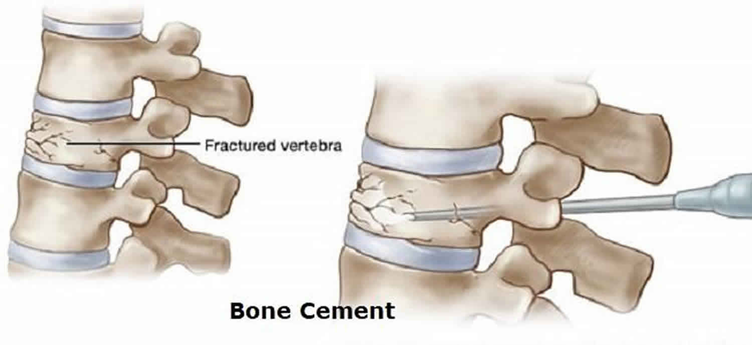 Bone Cement Polymethylmethacrylate Bone Cement
