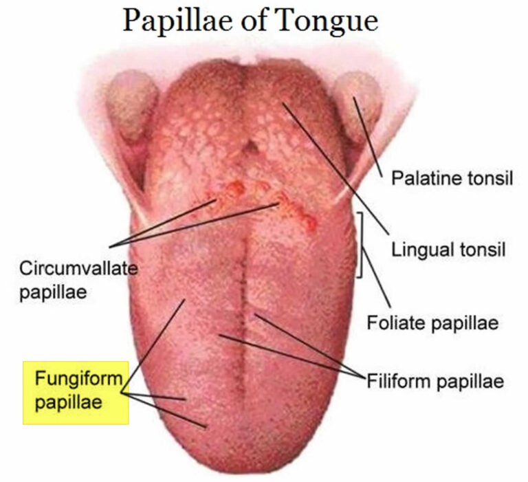 Eruptive Lingual Papillitis Causes Symptoms Diagnosis And Treatment