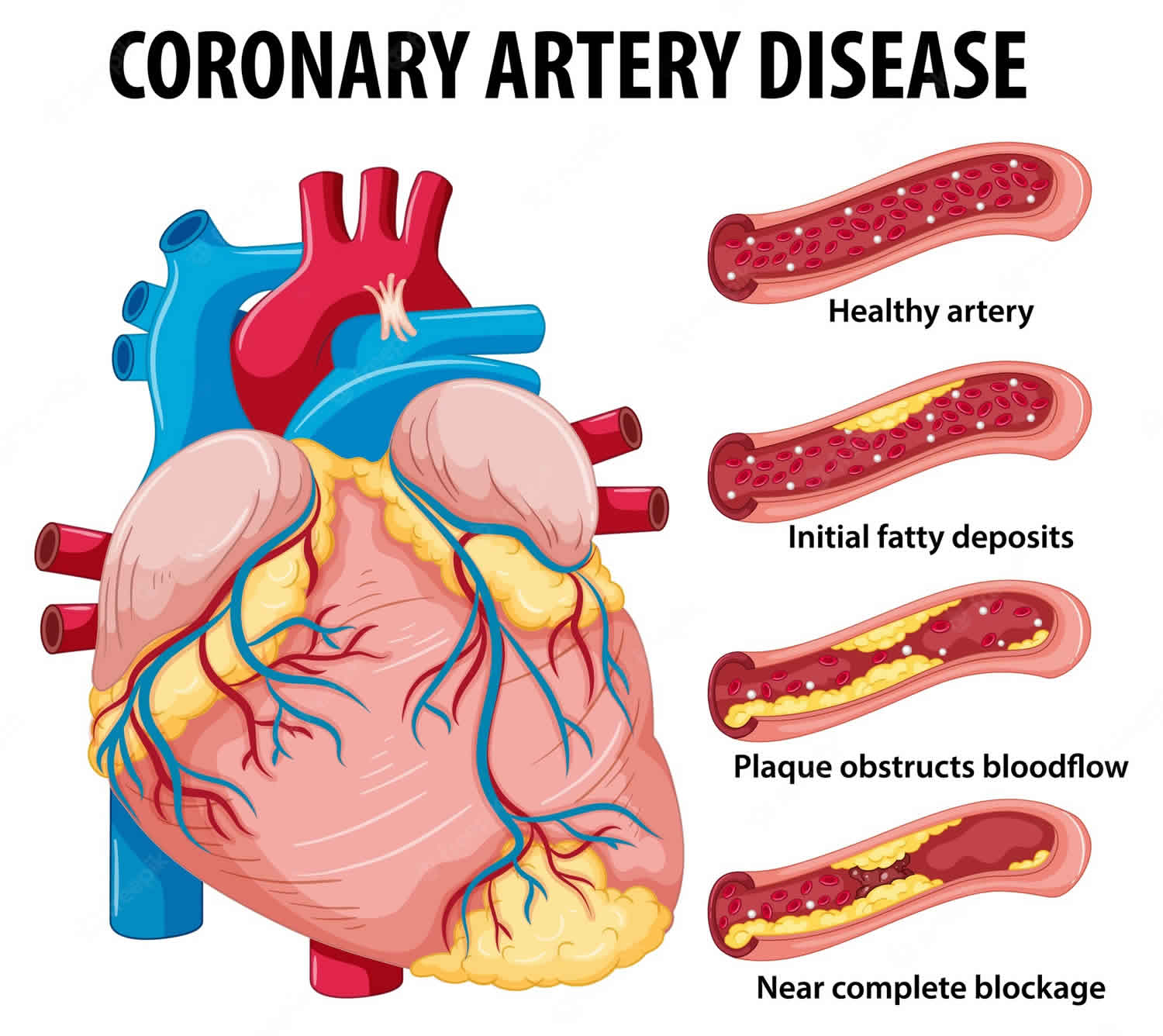 Coronary Artery Disease Causes Risk Factors Symptoms Diagnosis