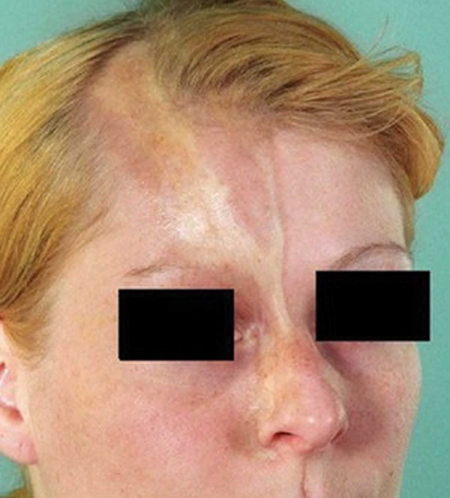Linear Scleroderma Causes Symptoms Diagnosis Treatment And Prognosis