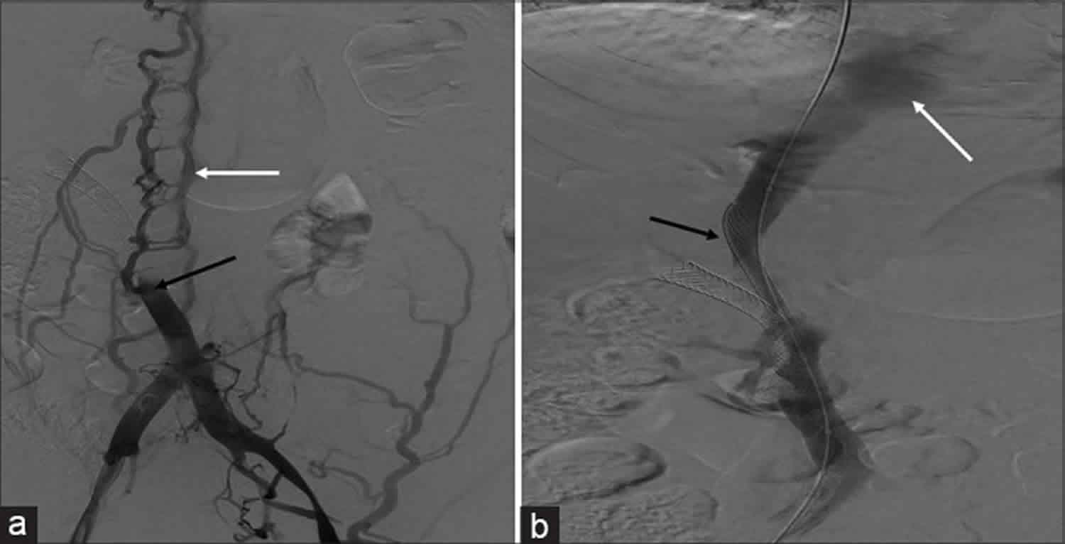 Inferior Vena Cava Syndrome Causes Symptoms Diagnosis Treatment And Prognosis